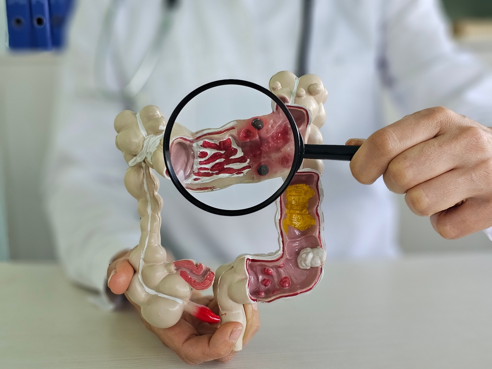 New Information About Early Colon Cancer Detection | Integrative ...